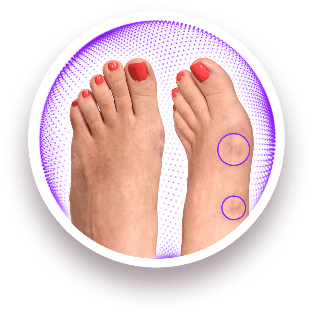 Bunionplasty® 360 Bunion Repair™ | Voom™ Medical Devices | Patent ...