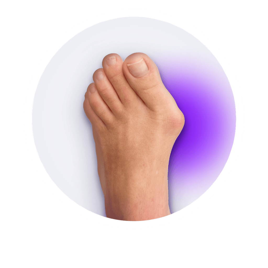 Bunionplasty® 360 Bunion Repair™ | Voom™ Medical Devices | Patent ...