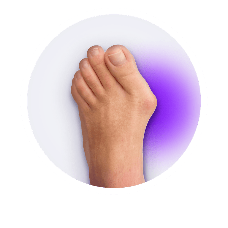 Bunionplasty® 360 Bunion Repair™ | Voom™ Medical Devices | Patent ...