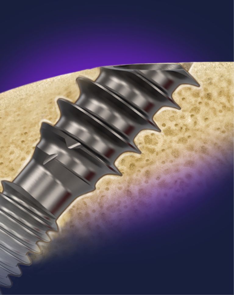 Revcon™ Screw System | Voom™ Medical Devices | Minimally Invasive ...